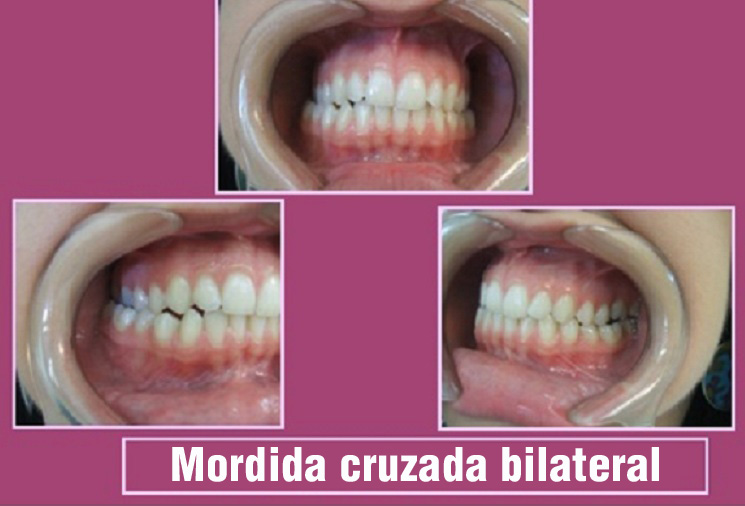 3.6.- Exploración intraoral. Exploración y diagnóstico de la oclusión ...