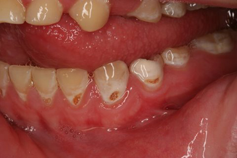 3.1.- Clasificación de la caries según el tejido dental afectado ...